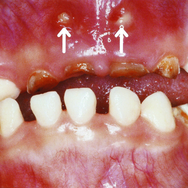 Teeth: three to five years » Whānau Āwhina Plunket